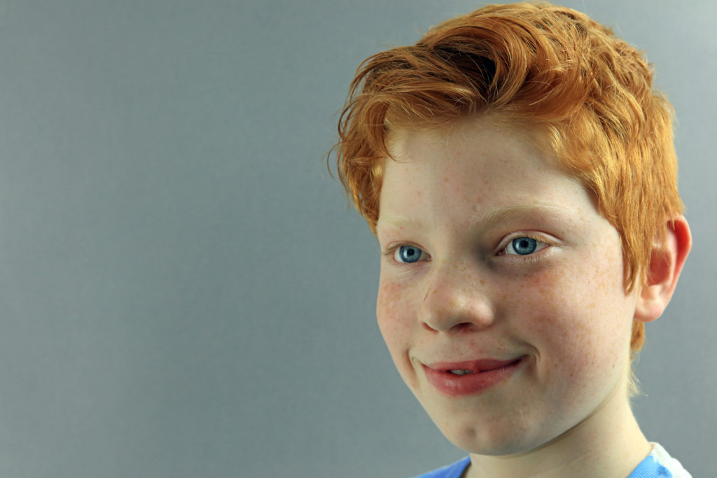 What is a Cleft Lip and Cleft Palate? - Davis Orthodontics